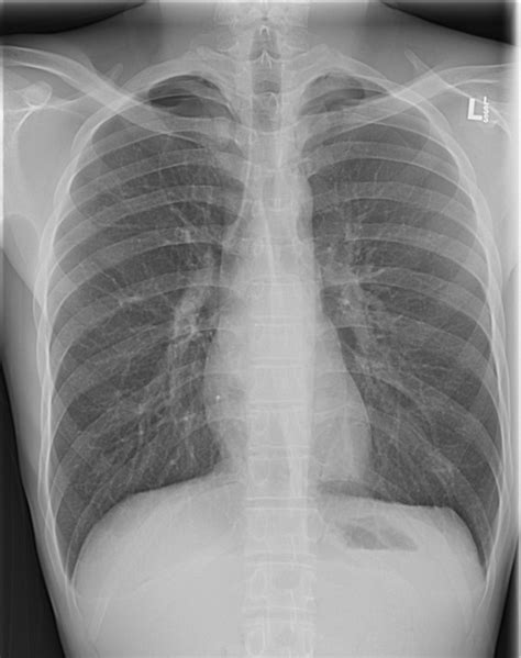 Грудная клетка