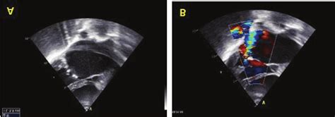 Echocardiography Showing Dilated Left Atrium Panel A And Severe