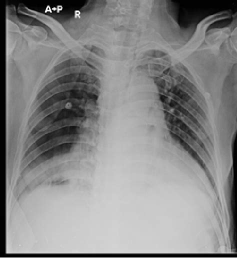 Figure 1 From Marantic Endocarditis And Lung Adenocarcinoma With Brain Metastasis A Diagnostic