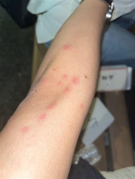 Rashes On Wrists Elbows Ant Idea What Could It Be R Dermatologyquestions