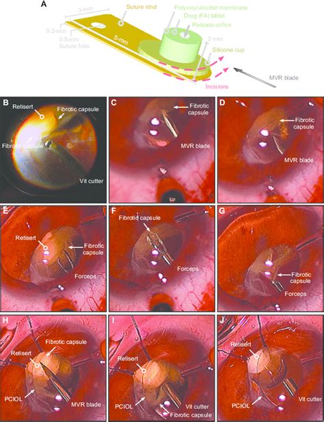 Surgical Dissection In Patient A Of Fibrotic Encapsulation Of Download Scientific Diagram