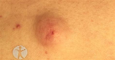 Cyst Image