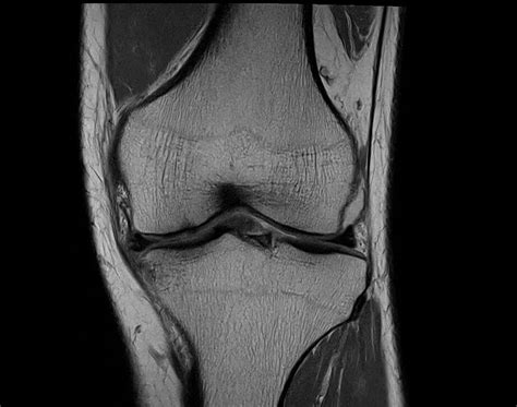 Proton Density Pd Weighted Mri Sequence Physics And Image Appearance