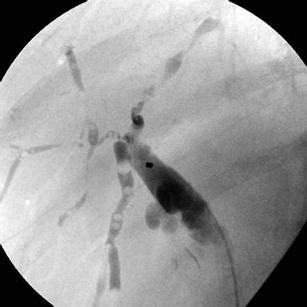 Primary Sclerosing Cholangitis Radiology Reference Article
