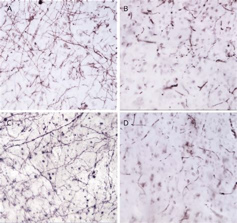 Regionally Selective Loss Of Cortical Cholinergic Axons In Primary