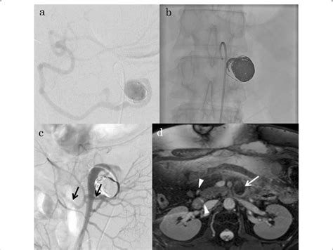 Images From Case 2 A Intra Aneurysmal Angiogram Immediately Before Download Scientific Diagram