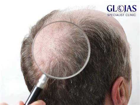 10 Proven Benefits Of Hair Implants Transform Confidence