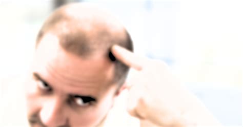 Scalp Lesion Removal Treatments Hairline Mole Removal
