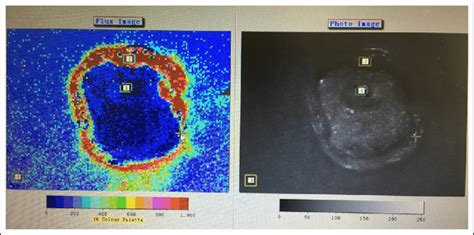 Microcirculation Detection Of A Grade Iv Pressure Ulcer 1 2 3 Shows