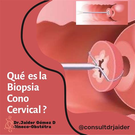 Jaider 📌la Biopsia Cono Cervical Es Un Procedimiento Mínimamente
