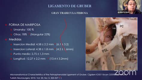 Session3 Dolleros Canal Y Ligamento De Gruber Microanatomia