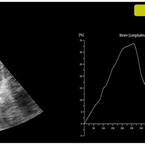 Left Atrial ε Analysis In The Four Chamber View By Using The Atrial