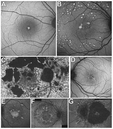 18 Faf In Pattern Dystrophies A Adult Onset Foveomacular Vitelliform