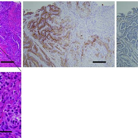 Pathological Biopsy Findings In He Staining Cells With Intranuclear
