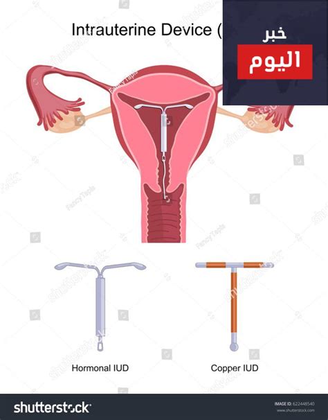 اللولب الجهاز داخل الرحم Iud Intrauterine Device بوابة خبر