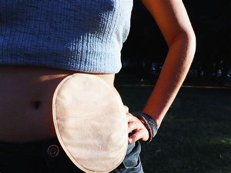Loop Colostomy Uses And Procedure Loop Colostomy Uses And Procedure
