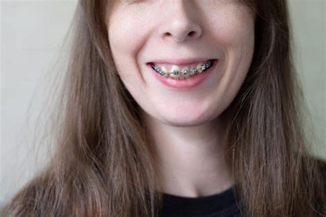 Premium Photo Womans Smile With Dental Braces To Correct An Overbite