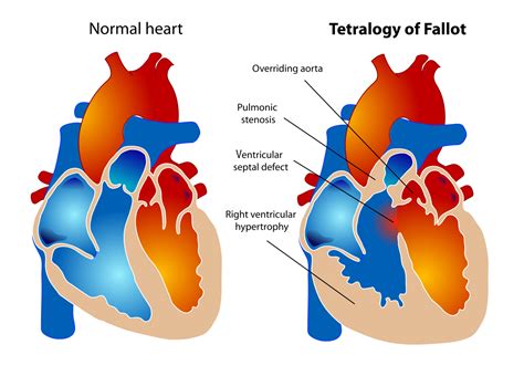 Infundibulum Of Right Ventricle