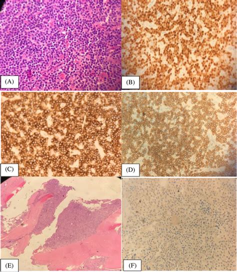 A Lymph Node Histopathology B Lymph Node Immunohistochemistry For Download Scientific