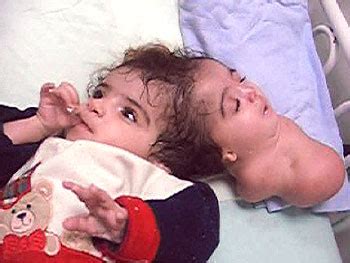Conjoined Twins Born With One Body