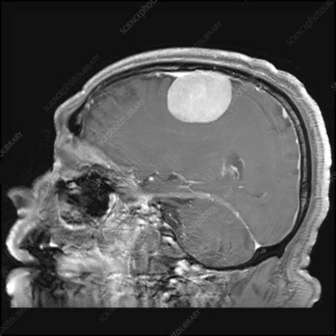 Large Meningioma On Mri Stock Image C0271688 Science Photo Library