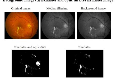 Figure 5 From Automated Detection Of Diabetic Retinopathy For Early Diagnosis Using Feature