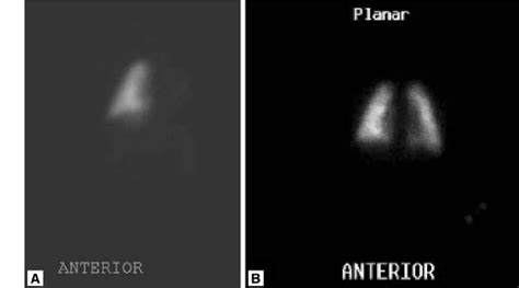 A Lung Perfusion Scan On Day 3 Of Life Showing Less Than 10 Perfusion Download Scientific
