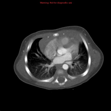 Aortic Ductus Diverticulum Radiopaedia 8339 9180 A Nc Commons
