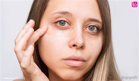 ویتامین های ضروری برای رفع گودی زیر چشم