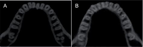 Figure 1 From The C Shaped Root Canal Semantic Scholar