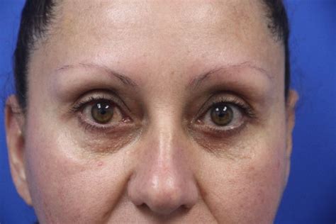 Blepharoplasty Case 4059 Dr Guy