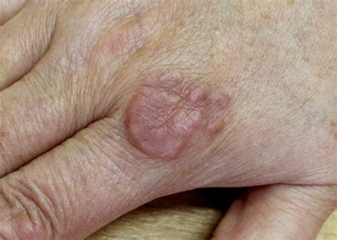 Granuloma Annulare Obat Penyebab Gejala Dll Hello Sehat