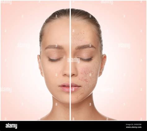 Young Woman With Acne Problem Before And After Treatment On Light