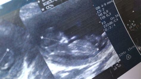 Sexo 12 Semanas E 3 BabyCenter