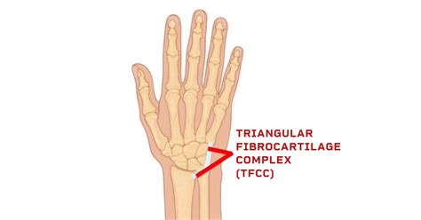 Tfcc Tear Causes Symptoms And Treatment Options
