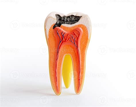 Decay Tooth Replace With Dental Implant Root Canal Teeth Model For
