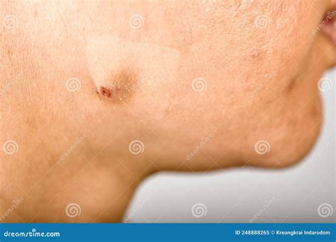 Skin Nodule Treatment