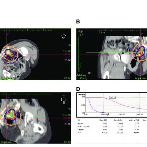 three dimensional conformal dose assessment for interstitial bt a