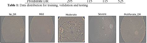 Table 3 From Classification Of Stages Diabetic Retinopathy Using Mobilenetv2 Model Semantic
