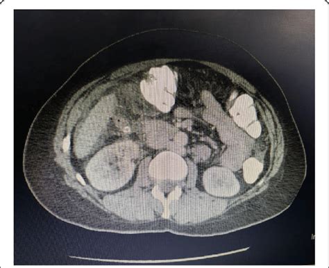 Computed Tomographic Images Showing Perforated Subhepatic Appendicitis