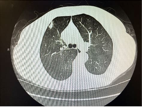 Video Atlas Of Pulmonary Segmentectomy Robotic Assisted Right S3 Segmentectomy With 3