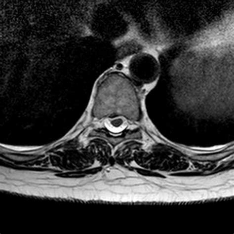 spine segmentation dataset mri images kaggle
