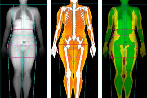 Understanding Your DEXA Scan Report