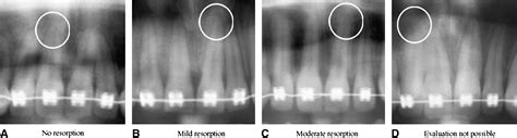 Treatment Of Apical Root Resorption At Gustavo Christensen Blog
