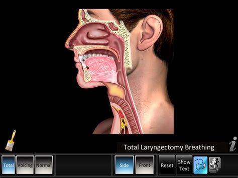 Laryngectomy