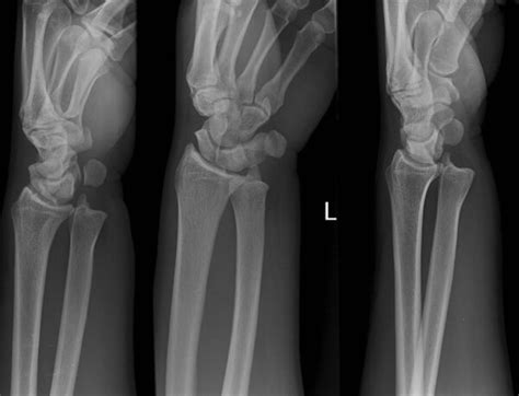 Distal Radioulnar Joint Dislocation Wikism Sports Medicine Wiki