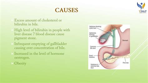 Ppt Gall Bladder Stone Anatomy Powerpoint Presentation Free Download