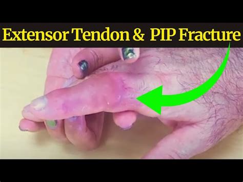 Extensor Tendon Repair Youtube