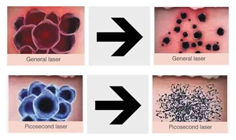 Pico Laser China YSV Group