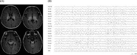 A Sleep Eeg At The Age Of 12 Months In A Standard Bipolar Montage
